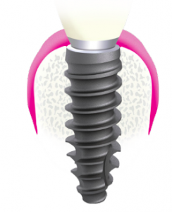 Easy Implants – Anpa Medical